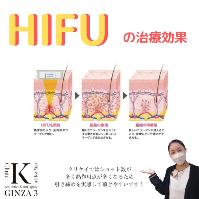 HIFUの治療効果 Column | 銀座1丁目の美容アンチエイジングクリニック Clinic K